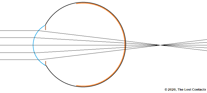 The Optics of Vision - Lesson 7: Hyperopia - The Lost Contacts